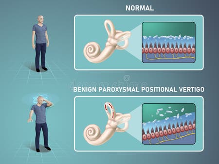 Benign Paroxysmal Positional Vertigo Stock Illustration - Illustration ...