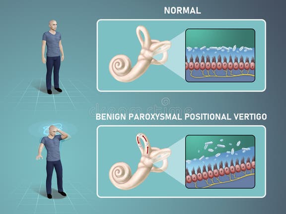 Benign Paroxysmal Positional Vertigo Stock Illustration - Illustration ...