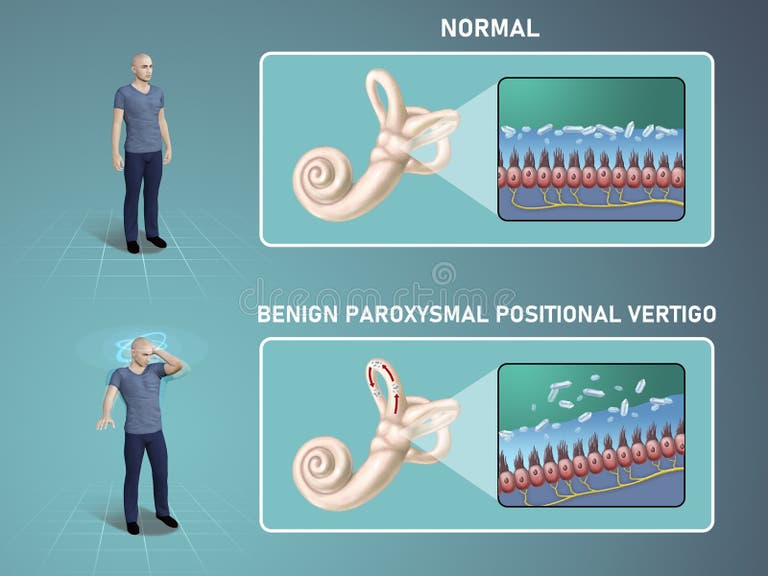 Benign Paroxysmal Positional Vertigo Stock Illustration - Illustration ...