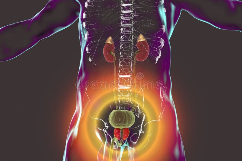 Benign Prostatic Hyperplasia Stock Illustration - Illustration of ...