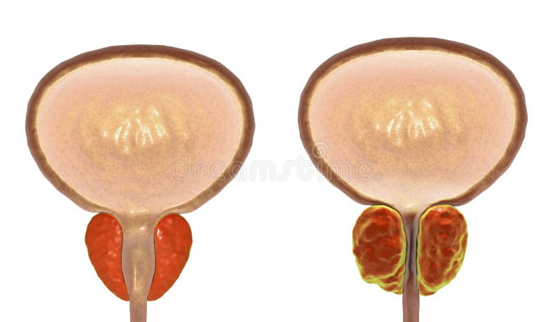 Benign Prostatic Hyperplasia Stock Illustration - Illustration of ...