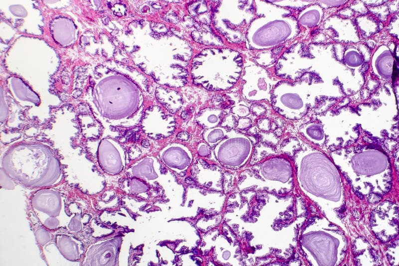 Benign Prostatic Hyperplasia Stock Image - Image of laboratory, biopsy ...