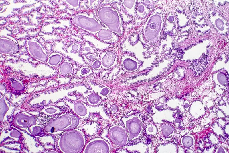 Benign Prostatic Hyperplasia Stock Image - Image of histology, core ...
