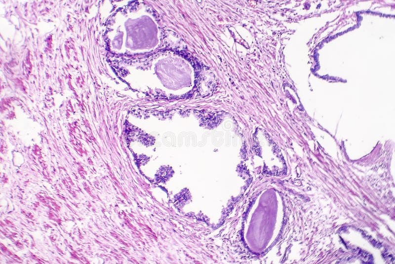 Benign Prostatic Hyperplasia Stock Image - Image of prostate ...