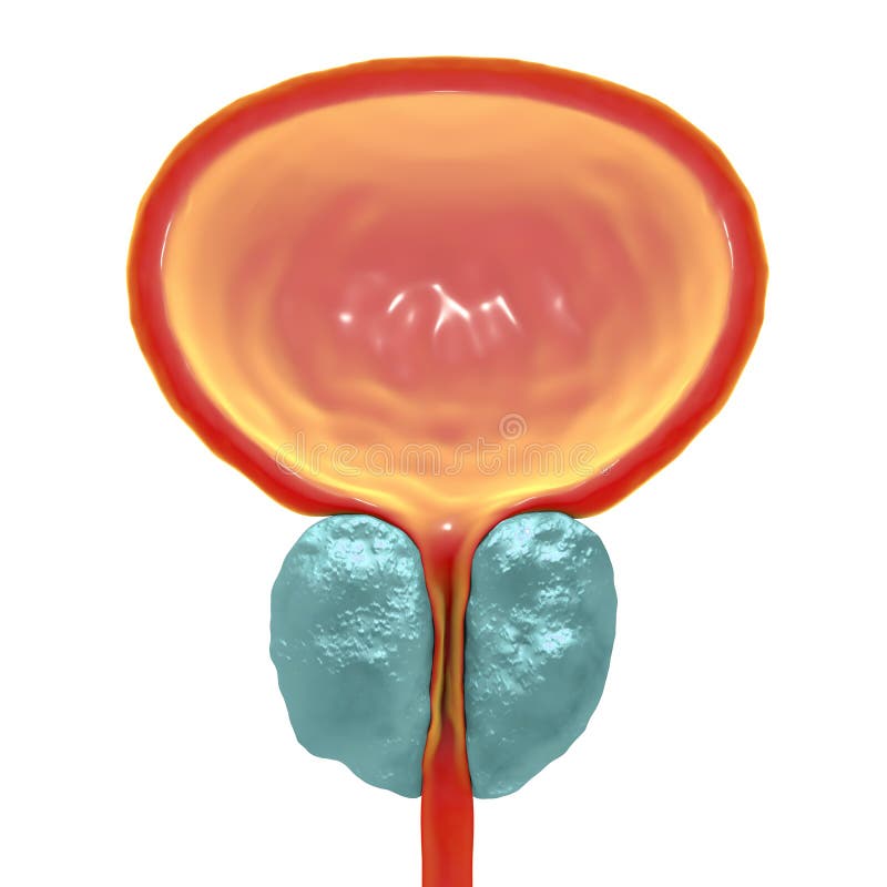 Benign Prostatic Hyperplasia Stock Illustration - Illustration of ...