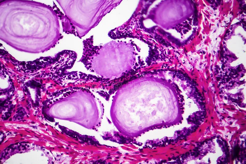 Benign Prostatic Hyperplasia Stock Photo - Image of microscopic ...