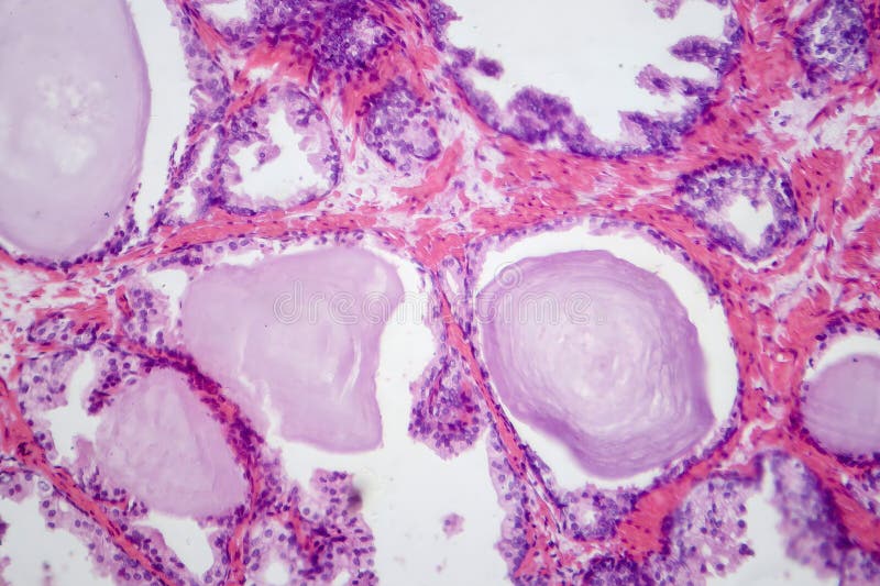 Benign Prostatic Hyperplasia, Light Micrograph Stock Photo - Image of ...