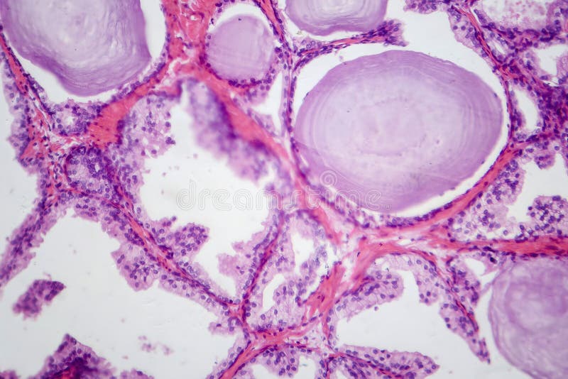Benign Prostatic Hyperplasia, Light Micrograph Stock Photo - Image of ...