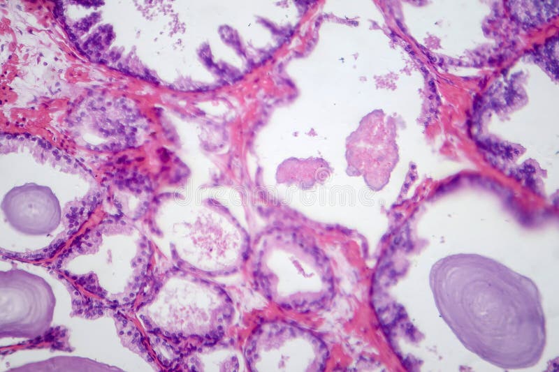 Benign Prostatic Hyperplasia, Light Micrograph Stock Photo - Image of ...