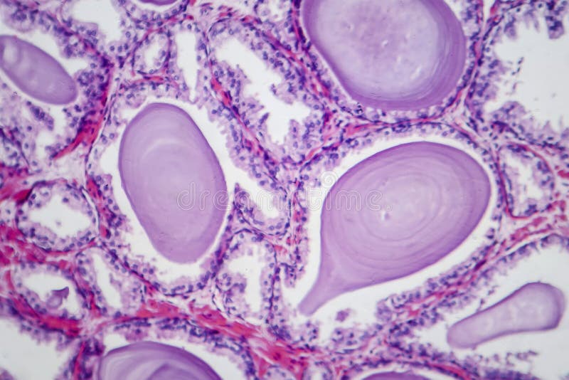 Benign Prostatic Hyperplasia, Light Micrograph Stock Image - Image of ...