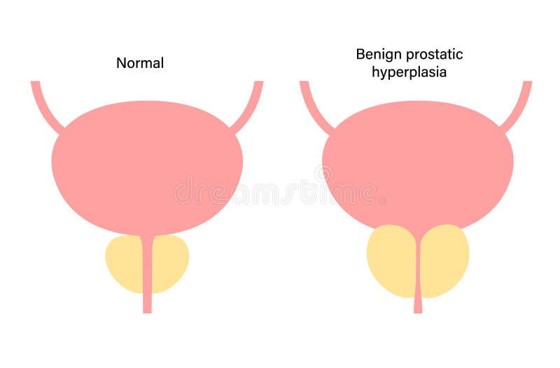 Bph Stock Illustrations – 265 Bph Stock Illustrations, Vectors ...