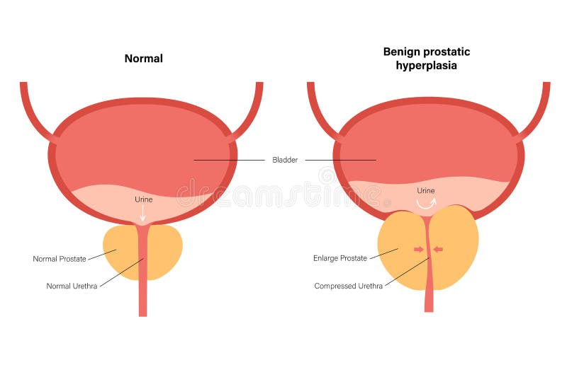 BPH info concept stock vector. Illustration of human - 203527000
