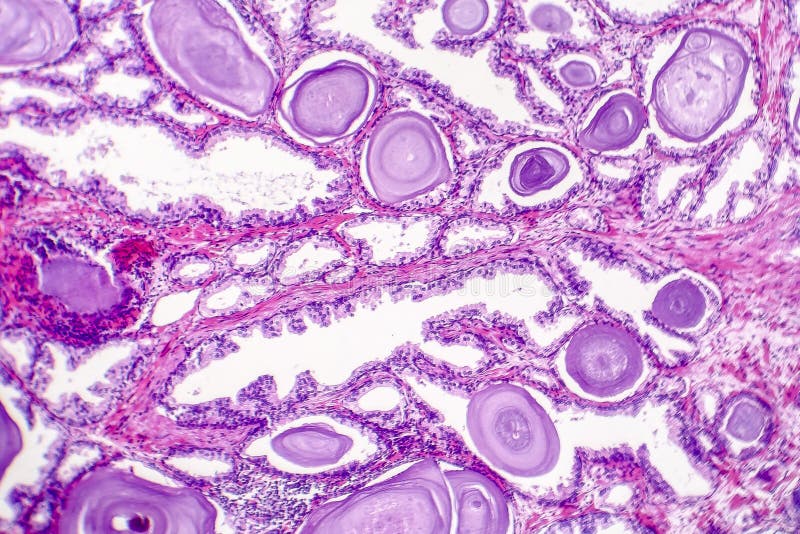 Benign Prostatic Hyperplasia Stock Photo - Image of magnification ...