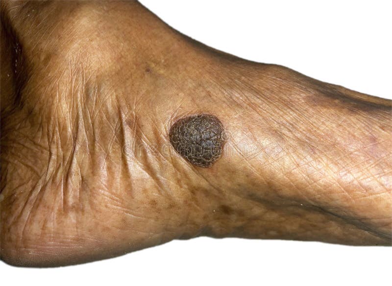 Benign Skin Growth or Single Large Mole in Foot of Asian Elder Man ...