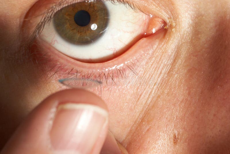 Infectie in Het Oog, Blaasbare Oogvaten Stock Afbeelding - Image of ...