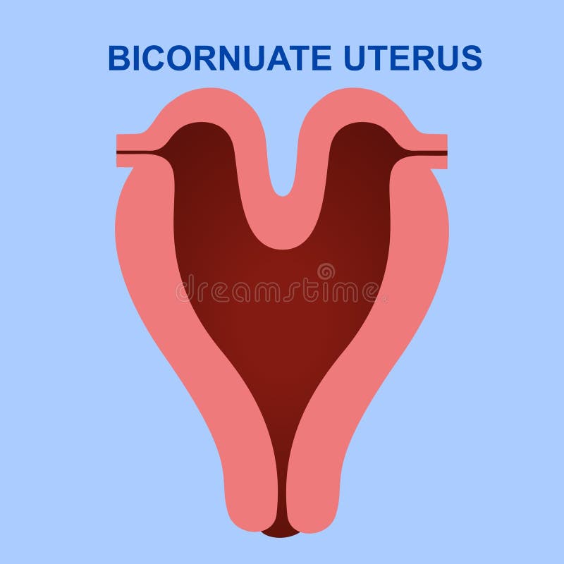 Bicornuate Uterus Is A Congenital Malformation That Occurs When The