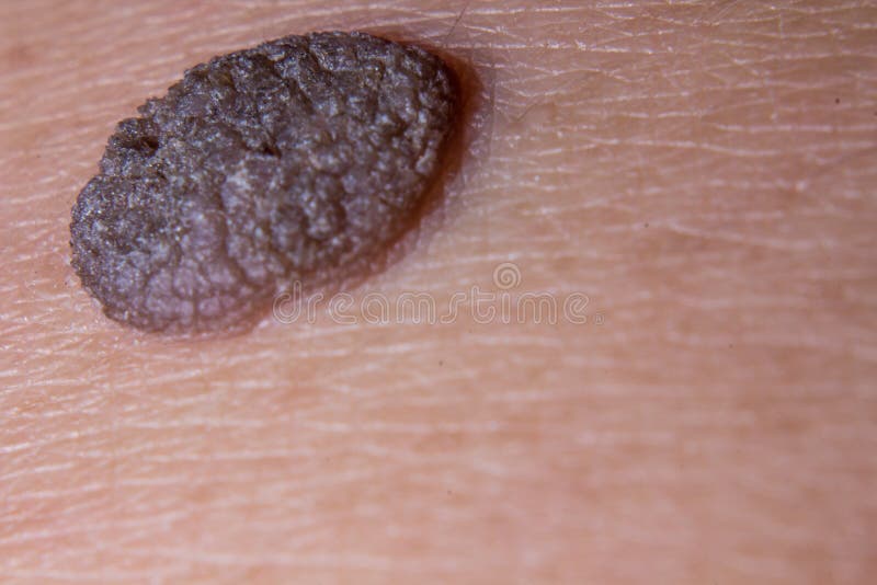 Mole removal inborn stock image. Image of benign, mole - 159731495