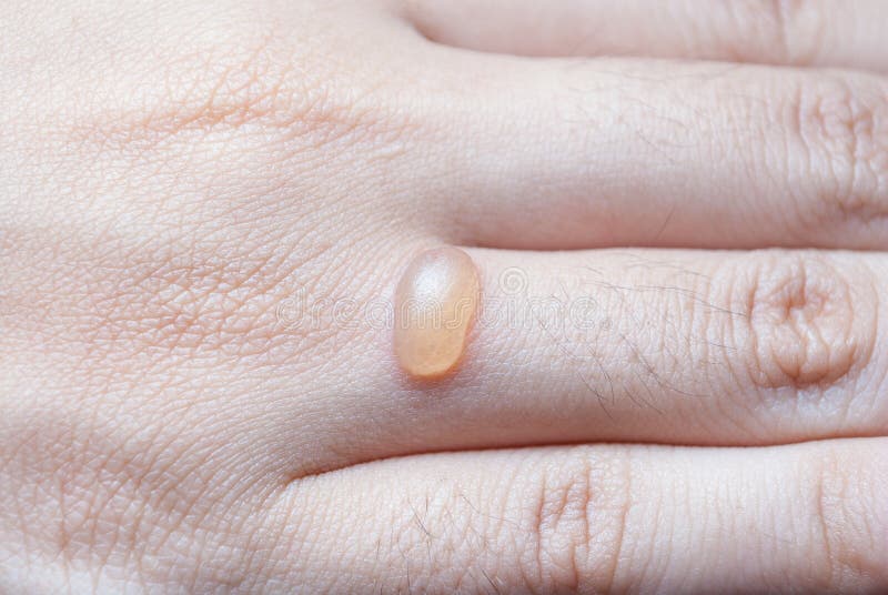 Big Blister on Human Finger Stock Photo - Image of pustule, vesicle ...