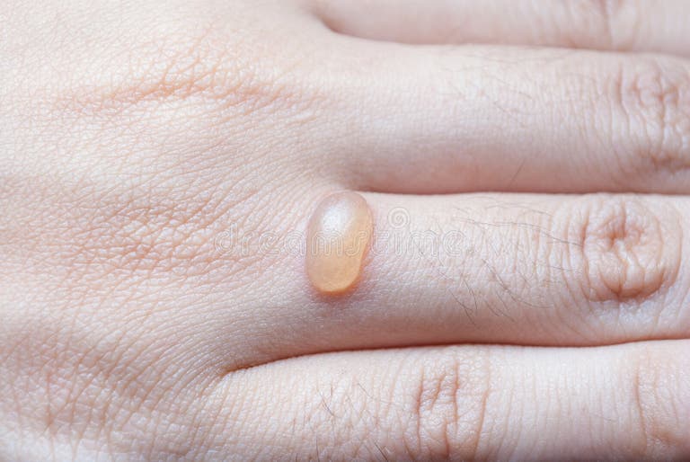 Big Blister on Human Finger Stock Photo - Image of pustule, vesicle ...