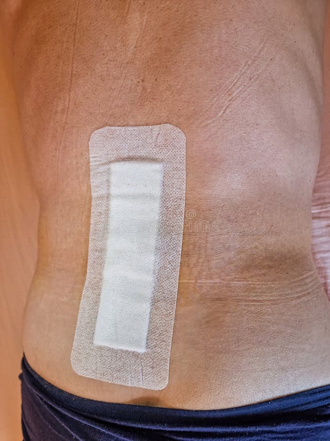Big Plaster on Men& X27;s Back after Spine Operation - Herniated Discs ...