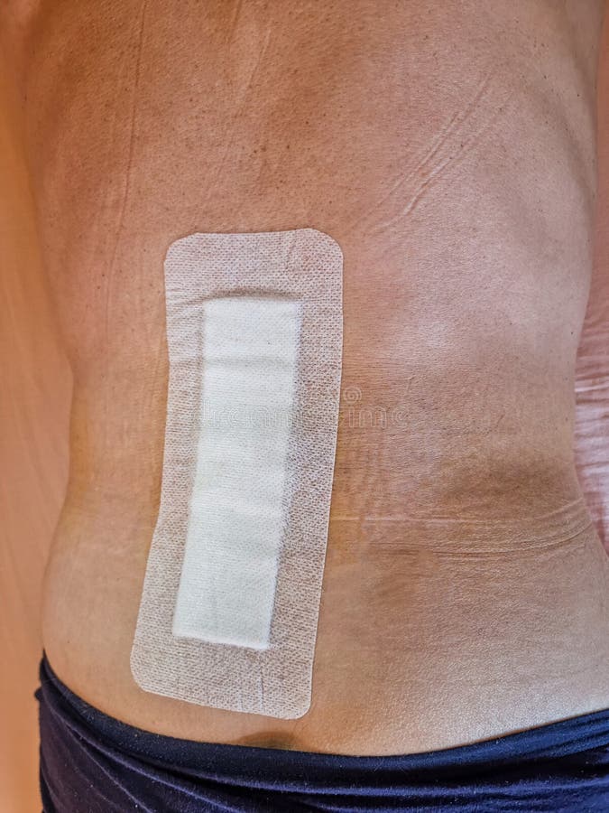 Big Plaster on Men S Back after Spine Operation - Herniated Discs ...