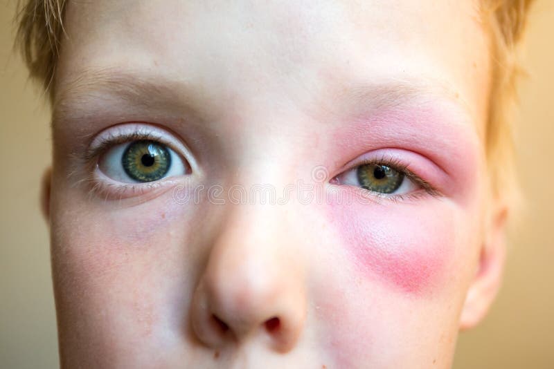 Big Red Bruise Under the Boys Eyes after a Bee Sting Stock Image ...