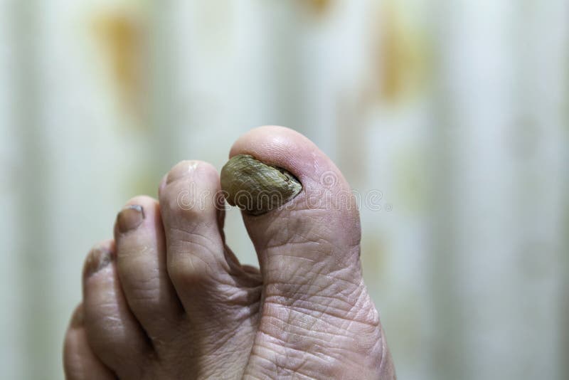 Big Toe with Fungal Nail Infection Stock Photo - Image of discoloured ...