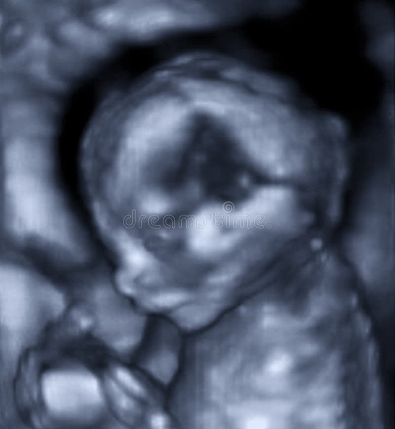 Bild Des Ultraschalls 3D Des Babys in Der Geb5rmutter Der Mutter ...