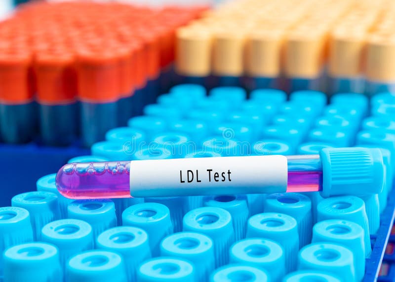 Biochemistry Blood Sample for LDL Low-density Lipoprotein Test Stock ...
