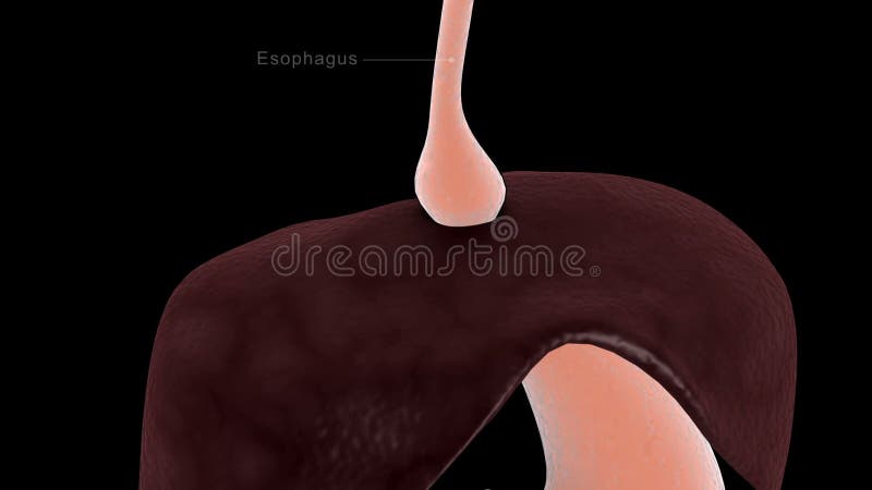 Biomedical Animation of a Hiatal Hernia in the Human Stomach Causing ...