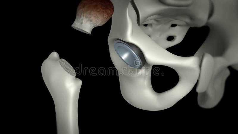 Biomedical Animation of a Hip Replacement Stock Video - Video of ...