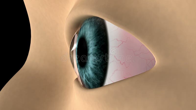 Biomedical Animation of Keratoconus Eye Disorder Stock Footage - Video ...