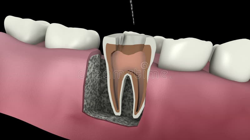 Biomedical Animation of a Root Canal Treatment Stock Video - Video of ...