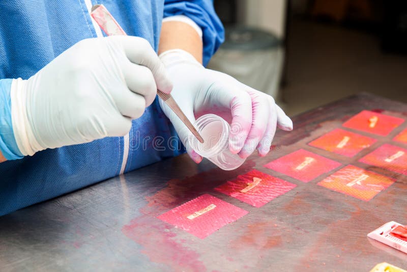 Biopsy Samples Being Processed at the Pathology Laboratory To Be ...