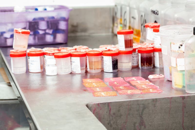 Biopsy Samples Being Processed at the Pathology Laboratory To Be ...