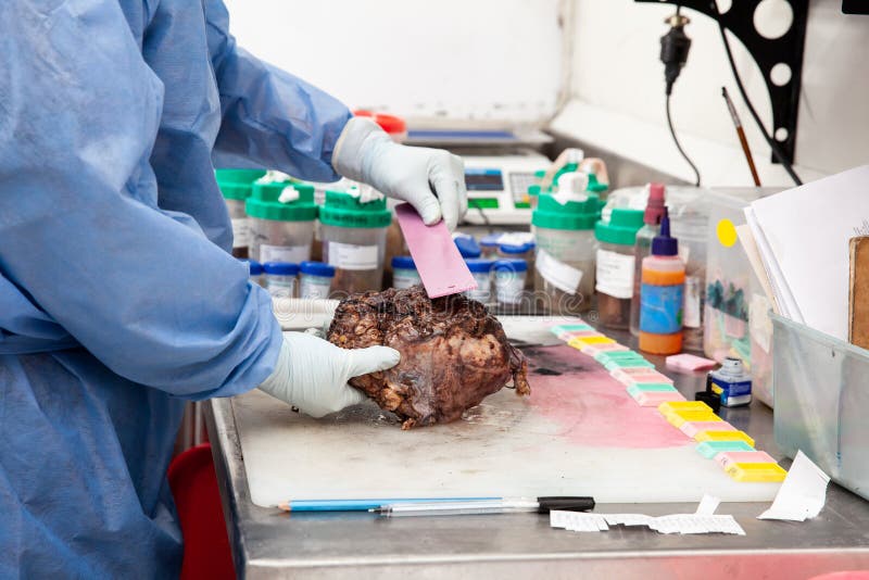 Biopsy Samples Being Processed at the Pathology Laboratory To Be ...