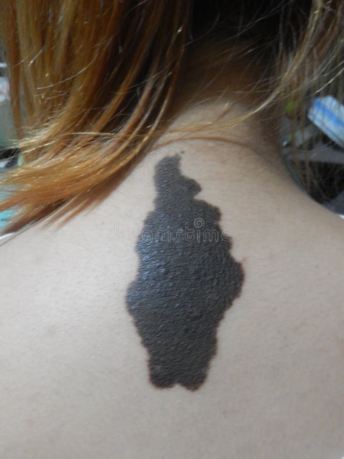 Birth mark editorial photo. Image of irregularity, occur - 87325651