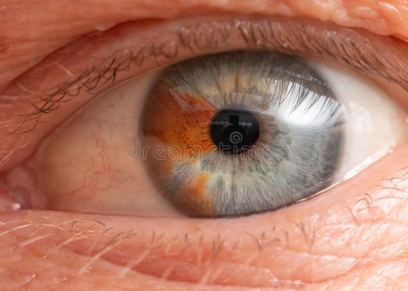 Birthmark in the Eye. Close-up. Stock Image - Image of retired, human ...