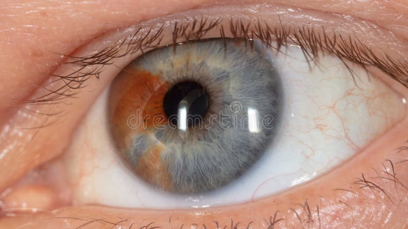 Birthmark on the Eye. Macro Stock Image - Image of face, mucus: 173613641