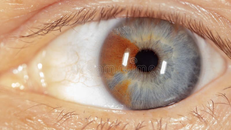 Birthmark on the eye stock image. Image of white, face - 146576101