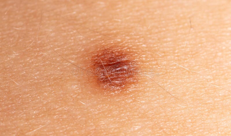 Birthmark on human skin. stock image. Image of skin - 144670135