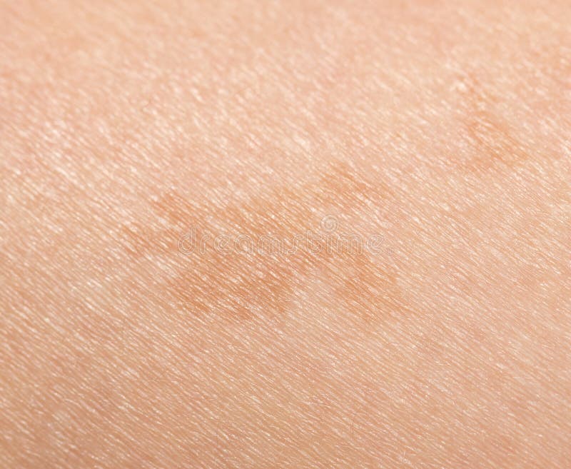 Birthmark on the Skin. Close Stock Image - Image of care, close: 93624391
