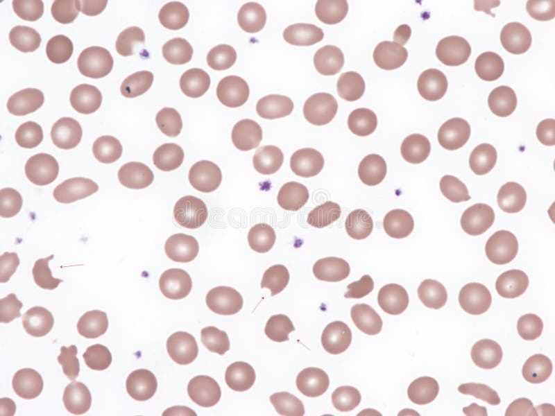 Bite cells. stock photo. Image of blister, glucose, anemia - 283972238