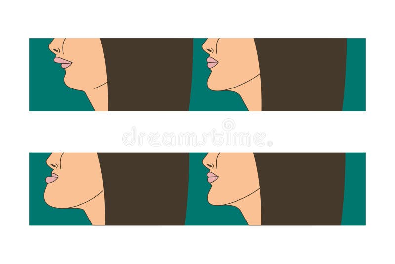 Distal Bite, Woman with Malocclusion Stock Vector - Illustration of ...