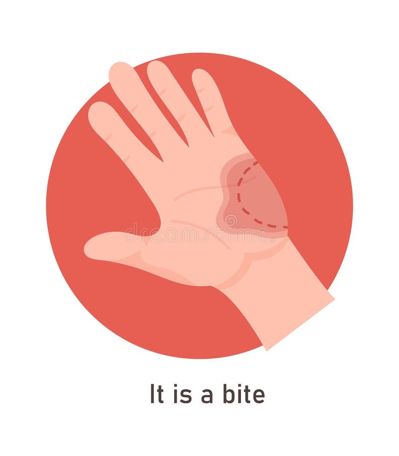 Bite on Hand Symptom stock vector. Illustration of itchy - 277675834