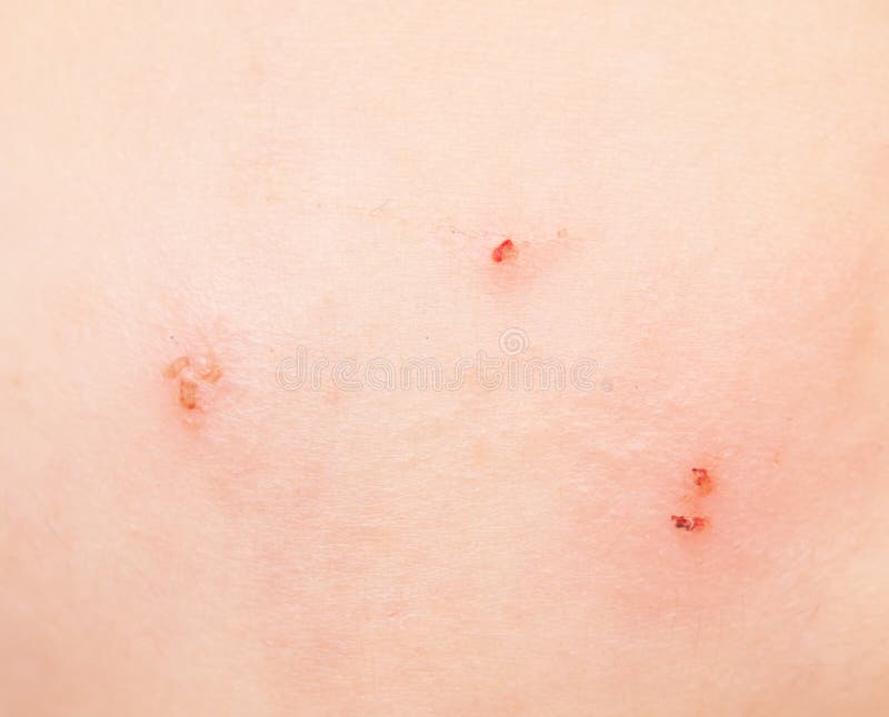 Bite stock image. Image of insect, pink, dermatology - 43833423