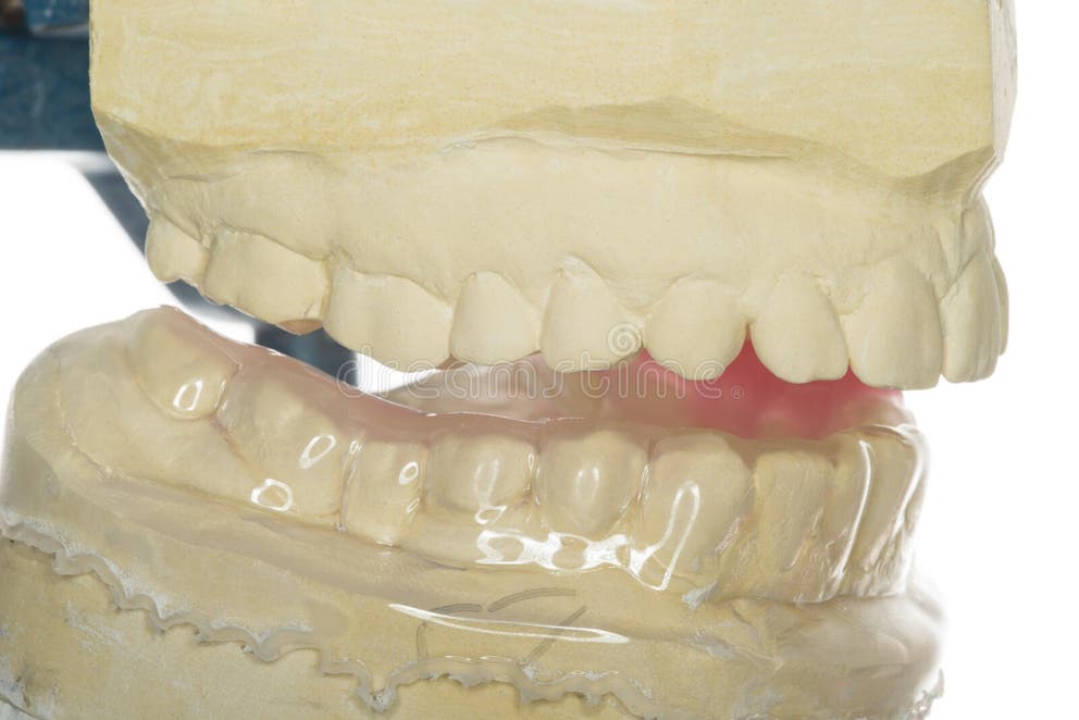Bite splint stock photo. Image of oral, dental, dentist - 30388004