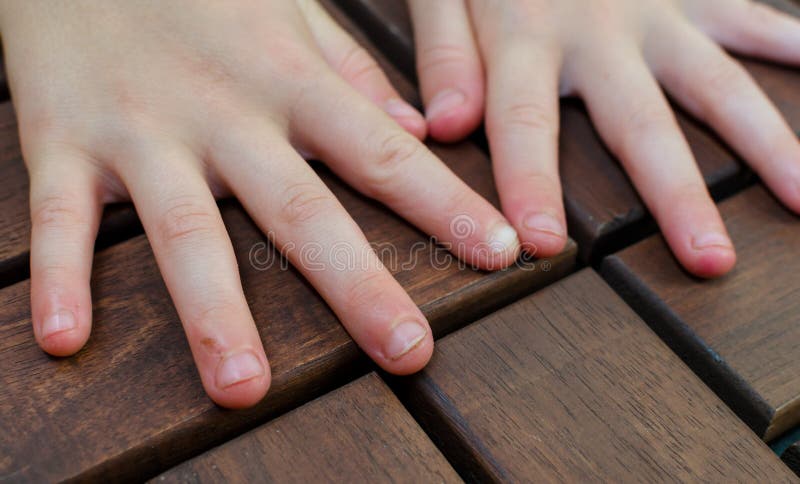 Bitten Fingernails - Bitten Fingers. Close Up of Hand with Bitten ...