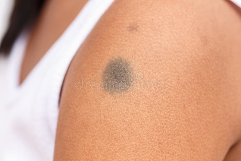 Birthmark on skin stock photo. Image of health, macro - 51469816