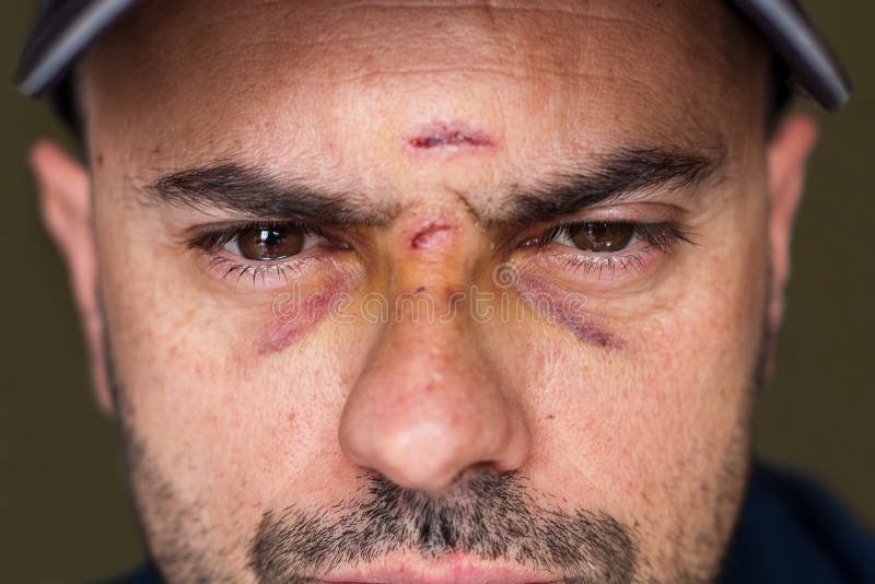 Black Eyes of a Injured Man Stock Image - Image of black, aggression ...